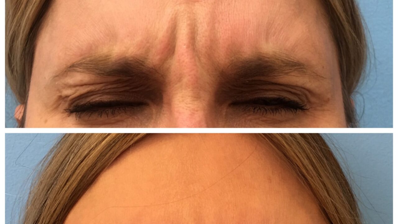 A Natural Expression with Botox® & Dysport® in Chicago