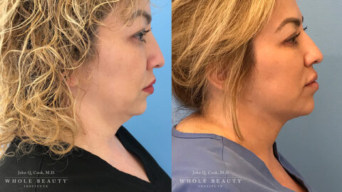 The Benefits of MyEllevate for Neckline Contouring