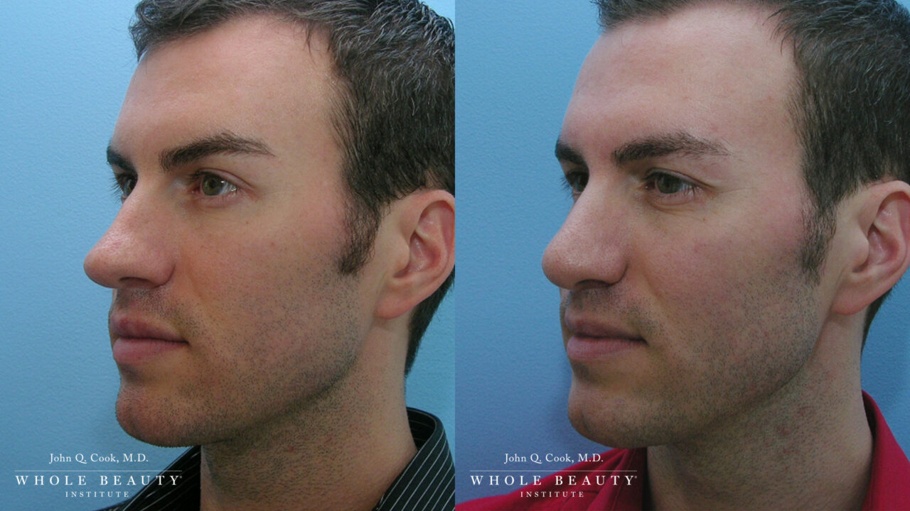 Face Surgery | Chicago, Winnetka | Dr. John Q. Cook